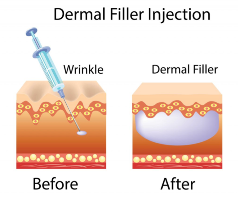 Dermal Fillers – Nia's House Of Beauty